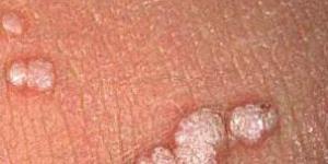 Como evitar o contágio das verrugas genitais - 6 passos